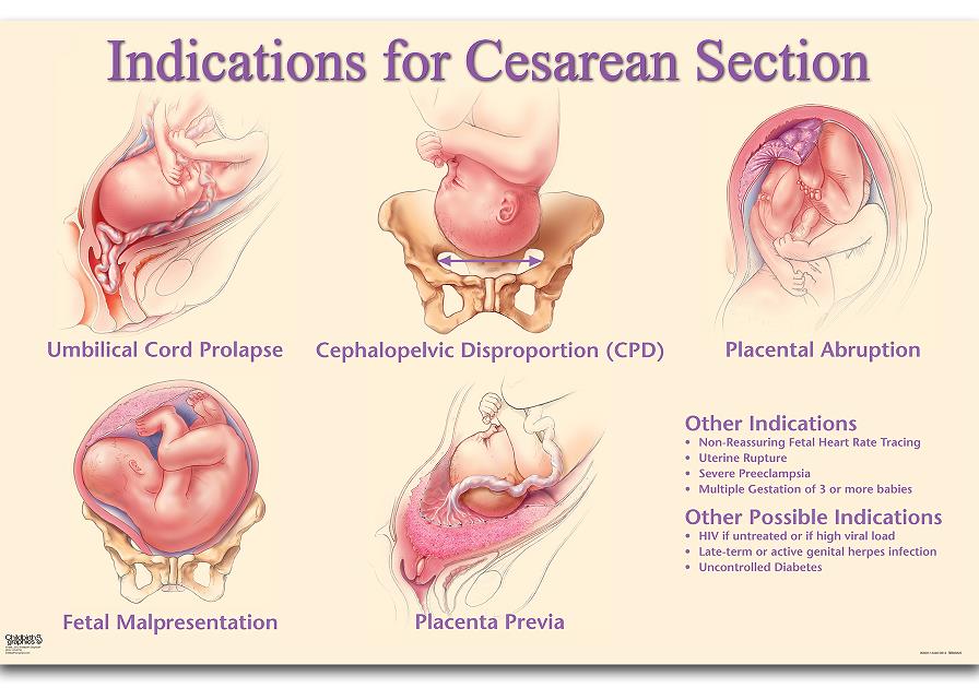 Five Facts About Cesarean Birth | Childbirth Graphics